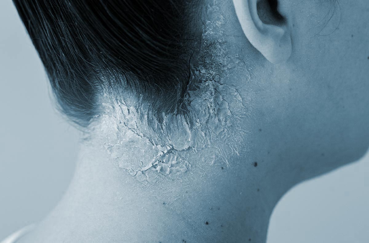 Skin Disease - Spine Acupuncture Wellness Centre